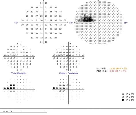 Branch Retinal Artery Occlusion Visual Field Defect