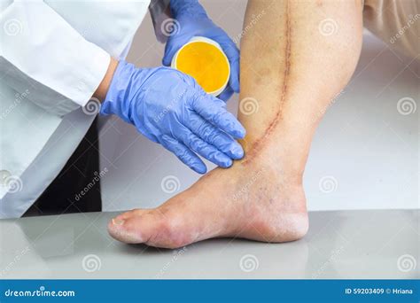Human Leg With Postoperative Scar Of Cardiac Surgery Stock Image
