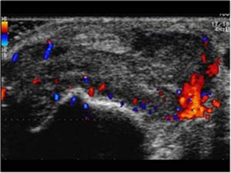 Musculoskeletal Joints And Tendons 64 Fingers Case 643 Arthritis Ultrasound Cases