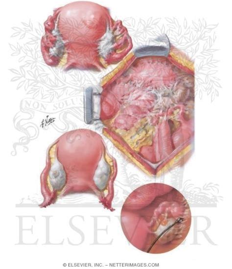 Chronic Salpingitis Adhesions Differential Diagnosis