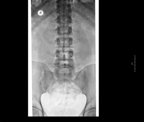 Спина бифида Портал радиологов