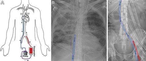 vv ecmo cannula placement