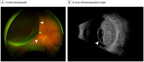Jama On Linkedin Immunotherapy For A Choroidal Pigmented Lesion
