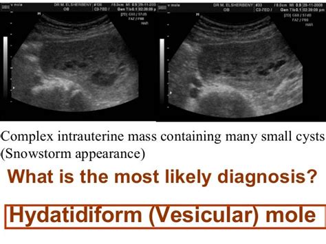 Hydatidiform Mole Molar Pregnancy Nurulhidayu