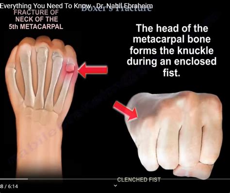 Boxers Fracture —