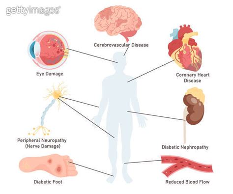 Diabetes Disease Complications Affected Human Organs Isolated Medical
