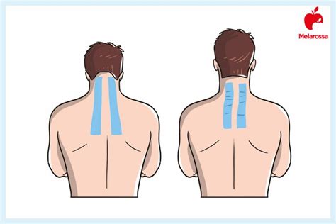 Kinesio taping che cos è a cosa serve come si usa benefici