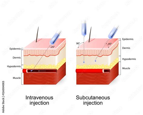 Intravenous Therapy And Subcutaneous Injection Stock Vector Adobe Stock