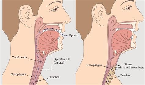 Laryngectomy