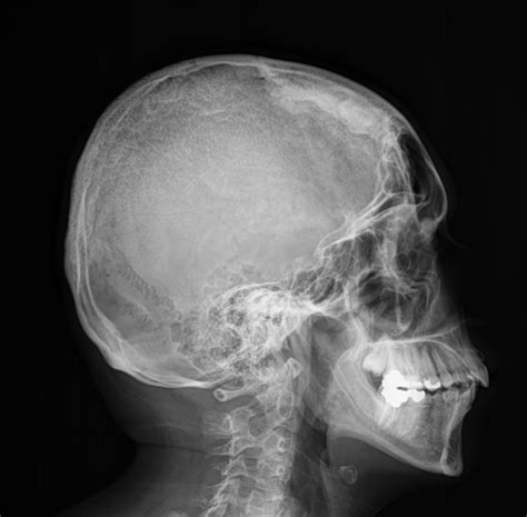 Hyperostosis Frontalis Interna Pacs