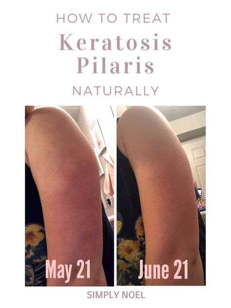 How To Get Rid Of Keratosis Pilaris Simply Noel Blog Small Bumps On