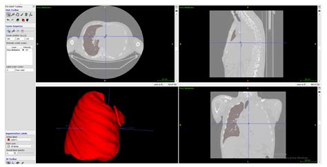 comparison of models for 3d printing of solitary fibrous tumor obtained