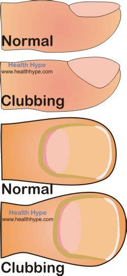 Fingernail Abnormalities Toenail Disorders Discolored Nails Healthhype