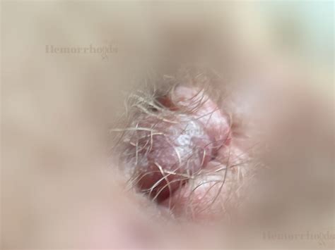External Hemorrhoid Real Pictures How Does It Look And Feel Like