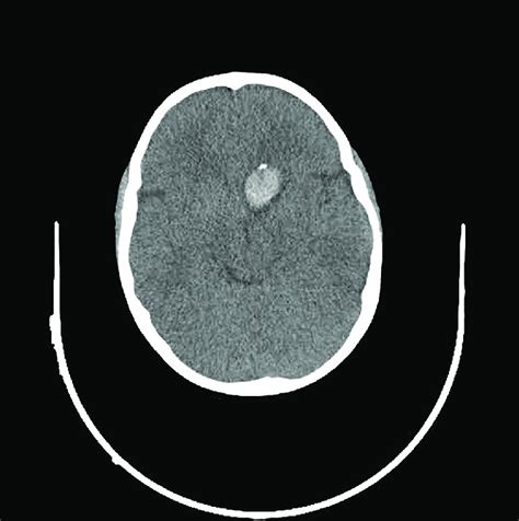 Axial Brain Computed Tomography Scan On Admission Showing A Small