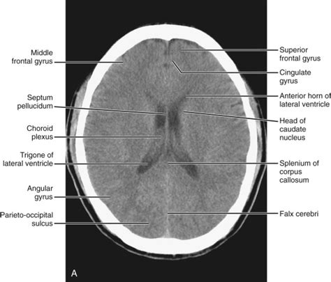 Normal Anatomy Radiology Key