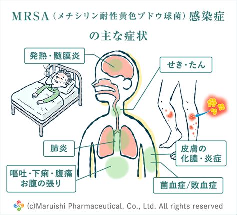 Mrsa感染症｜感染症ってなに？｜｜感染対策コンシェルジュ