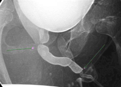 Urethral Stricture