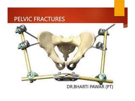 Pelvic Fracture Ppt By Drbharti Pawarppt