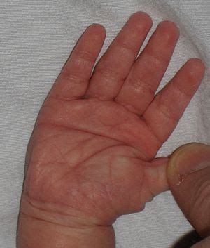 Single Transverse Palmar Crease Wikipedia