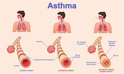 Anatomie Des Asthmas Medizinisches Diagramm Das Die Stadien Eines