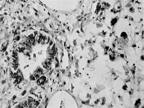 Uterine Sarcoma Histology Classification And Prognosis Glowm
