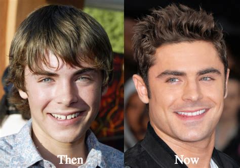 Zac Efron Plastic Surgery Before And After Photos