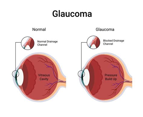 Premium Vector Diagram Of Glaucoma Affected Human Eye And Normal Eye