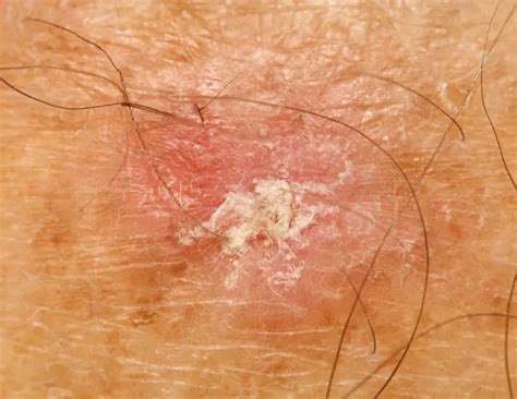 Actinic Keratosis Treatment Fairview Dermatology