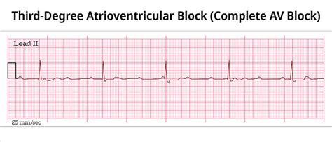 Ecg Third Degree Atrioventricular Block Complete Av Block 8 Second Ecg