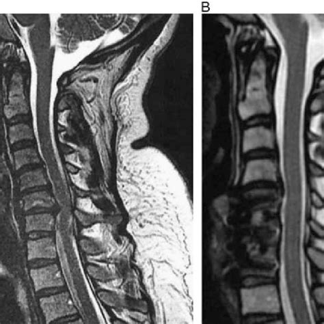 Pdf Effect Of Cervical Decompression Surgery On Gait In Adult