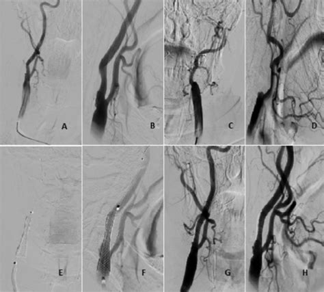 67 Years Old Male Patient With History Of Right Side Hemiplegia