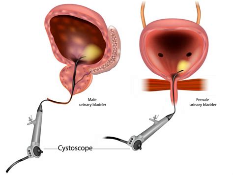 Hematuria Integrative Urology