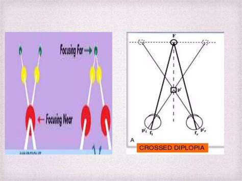 Treatment Strategies For Routine Binocular Vision Problems Pptx