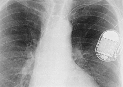 Implantable Cardioverter Defibrillator Icd 2 Minute Medicine