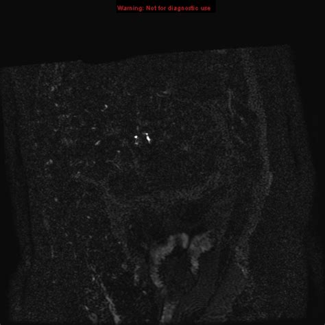 Biliary Tree Anatomical Variant Biliary Trifurcation Radiopaedia