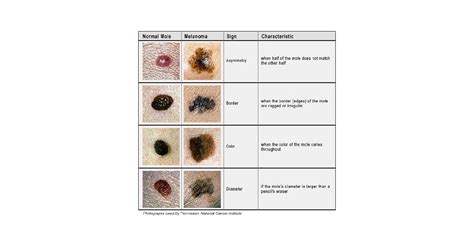 4 Warning Signs Of Skin Cancer Popsugar Fitness