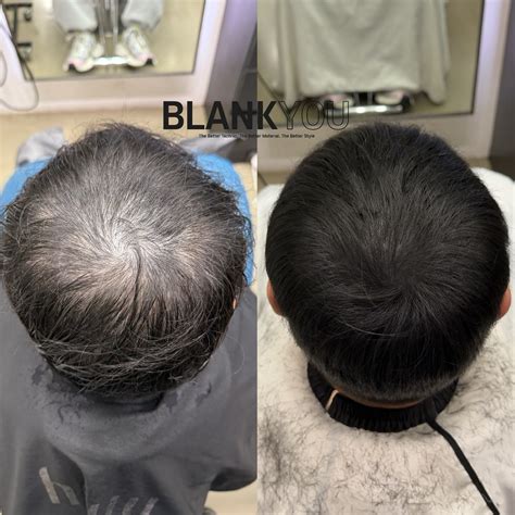 정언서일류 안녕하세요 블랭크유 일류입니다🦊 M자 탈모인데 시스루댄디 가능할까요 늘 앞머리 볼륨감이 죽고 숱이 부족해 스타일이 아니라 비어보이는 고객님 탈모 와