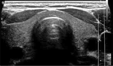 Gray Scale Ultrasound Images Show Homogeneous Thyroid Parenchyma In A Download Scientific