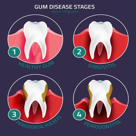 Warning Signs Gum Disease Falls Park Dentistry