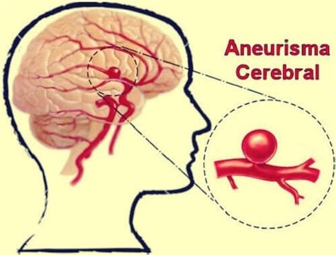 Aneurisma cerebral definición síntomas y tratamientos