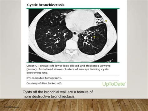 Bronchiectasisppt