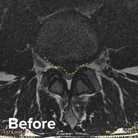 How To Treat A Herniated Disc Without Surgery In Raleigh Nc