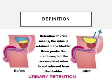 Retension And Incontinence Of Urinepptx