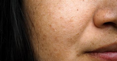 Vascular Lesions Laser Removal — Skin Md Dermatologist In Ortigas Pasig