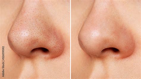 Blackheads On Face Up Close