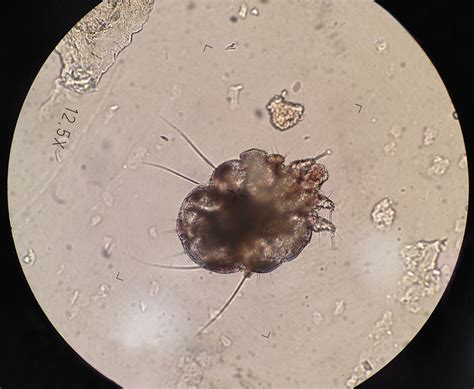 Mineral Oil Scabies Preparation From Under The Fingernail Mdedge