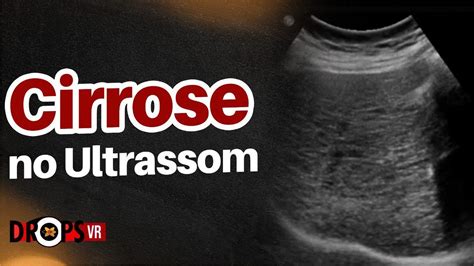 Cirrose Aprenda A Reconhecer No Ultrassom I VocÊ Radiologista Youtube