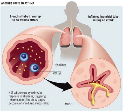 Asthma Linked To Hybrid Immune Cell New Scientist