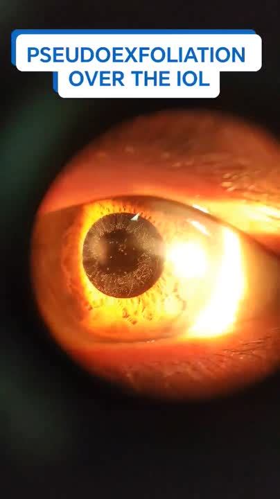 Ahmed Omara On Linkedin Pseudoexfoliation Over The Iol 13 Comments